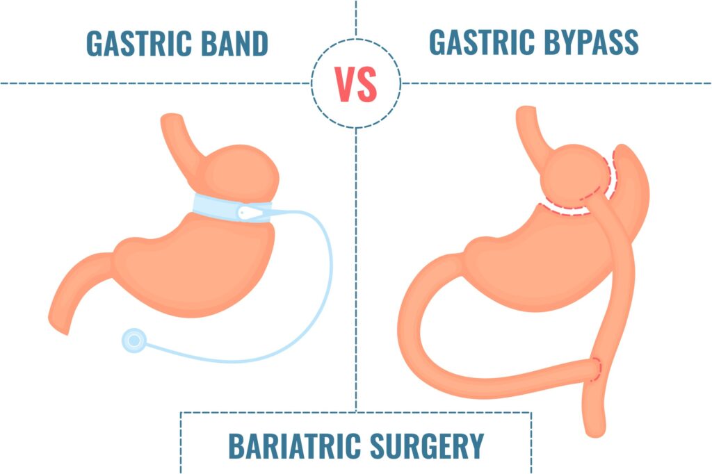 Bariatric Revision Surgery - Go Surgery Tijuana